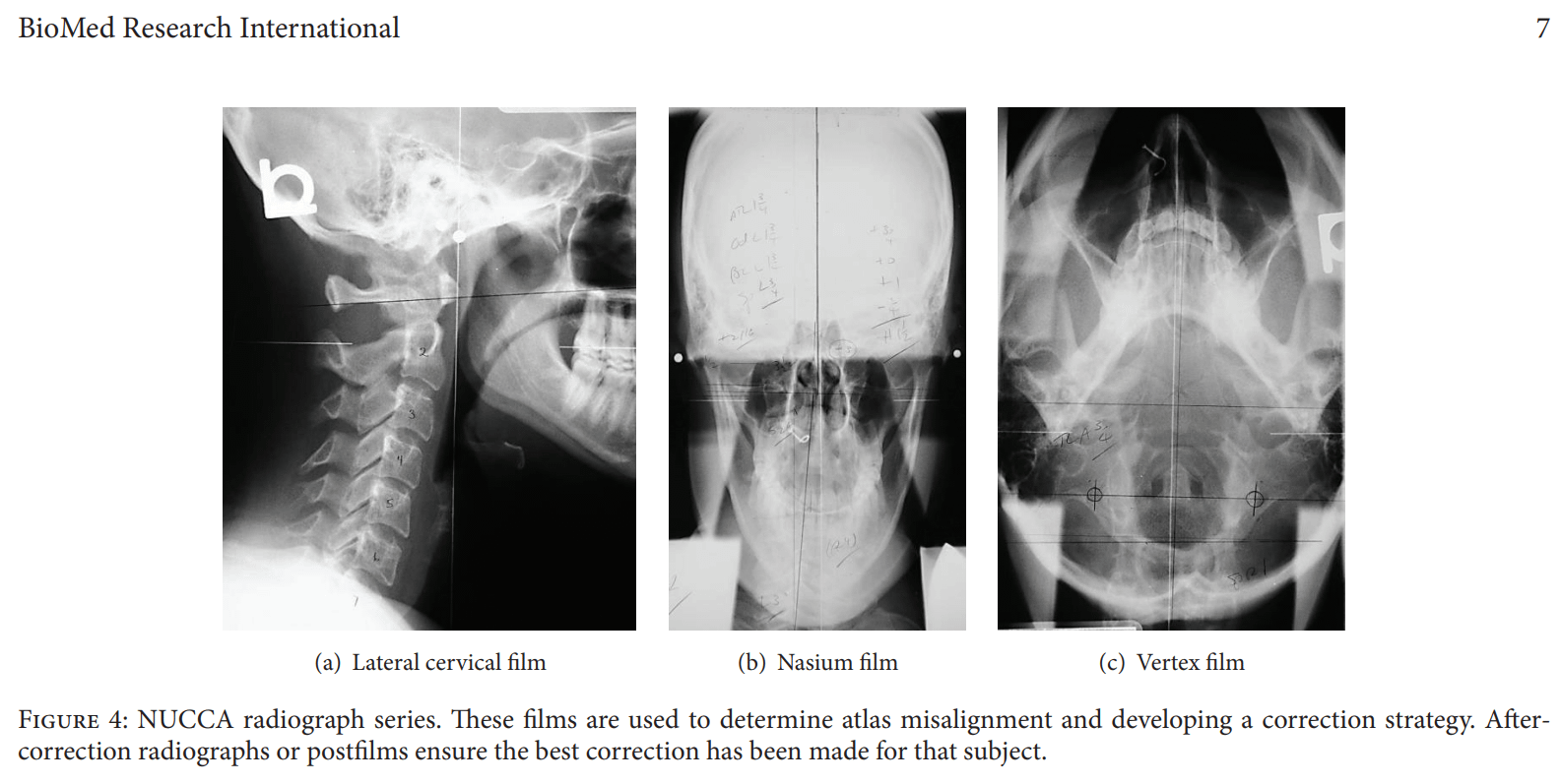 The Root Cause of Complex Health Problems: Atlas Subluxation