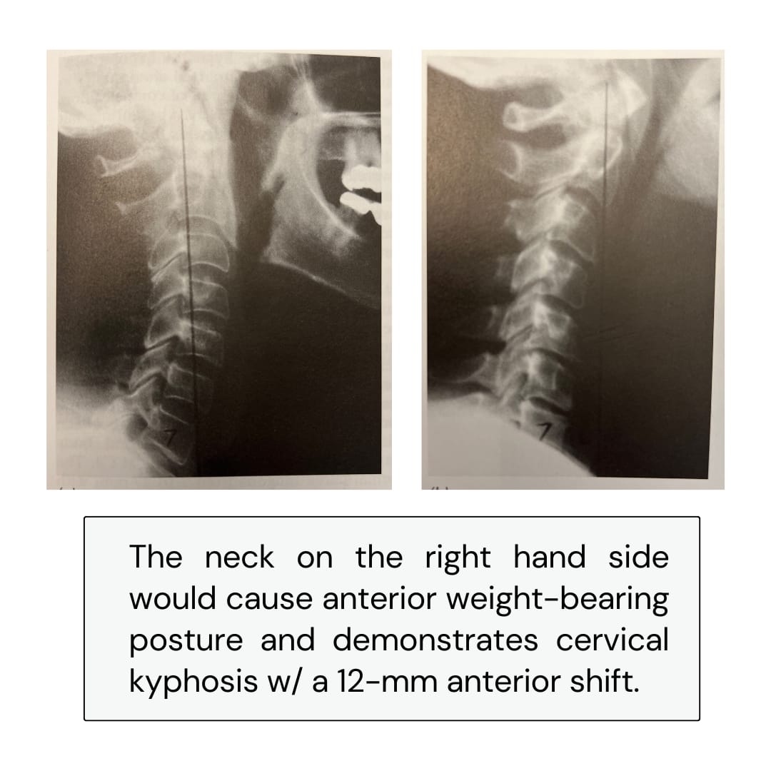 Upper Cervical Misalignment: What You Should Know
